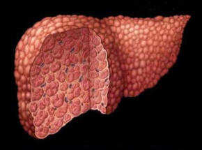 Lesion Inducida por Farmacos: Lesion Hepatica