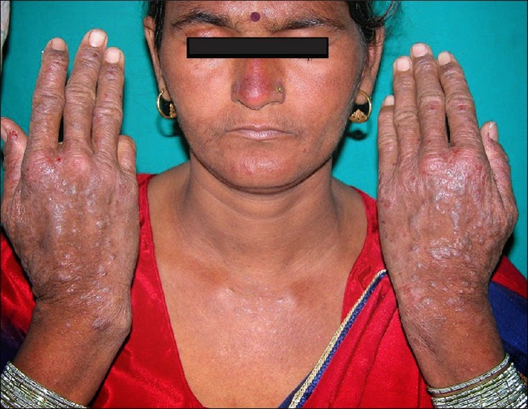 Teledermatology for PG entrance: Air Borne contact dermatitis (ABCD)