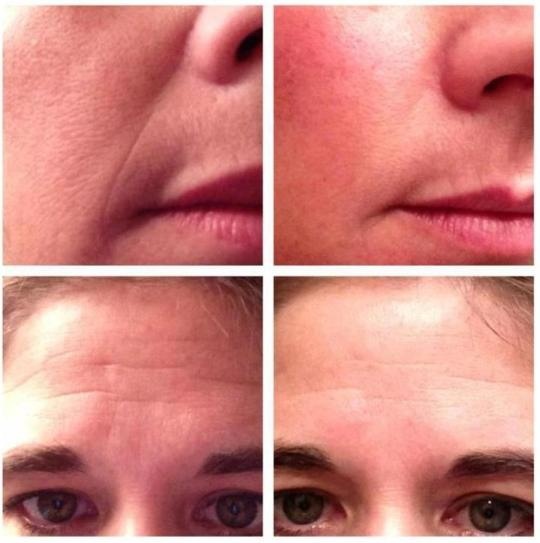This Skin I'm In : REDEFINE MACRO Exfoliator Before & After Pics