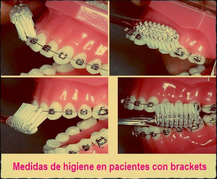 ORTODONCIA: Medidas de higiene en pacientes con brackets