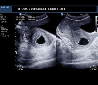 cochinblogs: Sonography in the case of pedunculated polyp