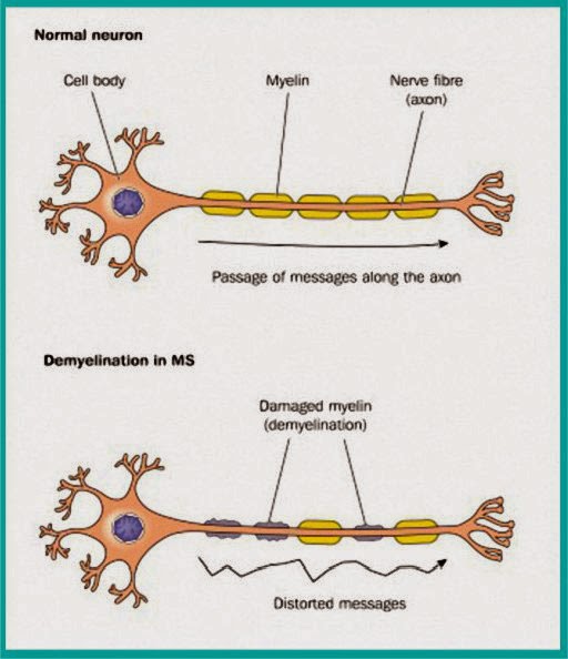 Multiple Sclerosis: What is Multiple Sclerosis?