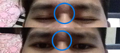 Rhinoplasty Diary, Fillers, Hiko - Nosejob Philippines: Line in Between ...