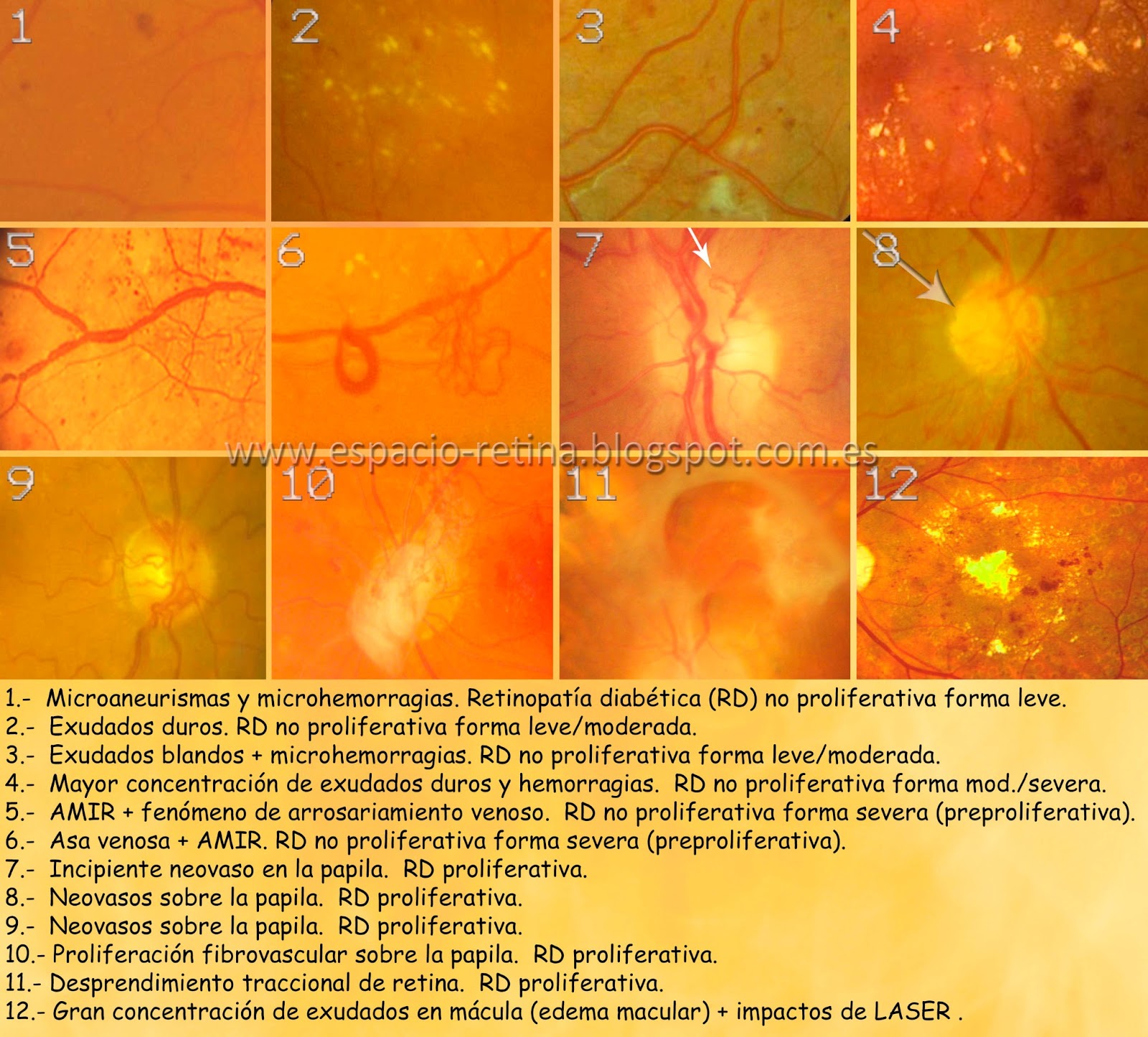 ESPACIO RETINA: Retinopatía diabética. Cronopatología.