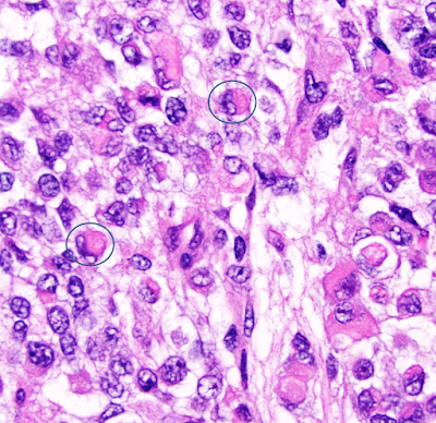 neuropathology blog: Atypical teratoid/rhabdoid tumor (AT/RT) in an infant