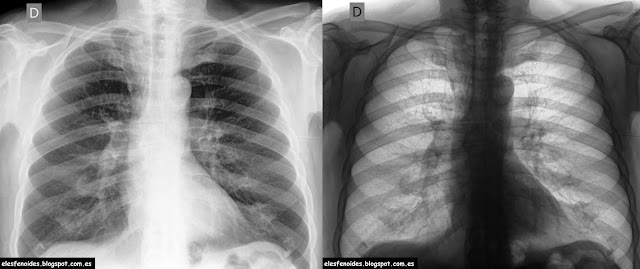 El esfenoides: Cisura de la ácigos. 2 imágenes 1 caso.