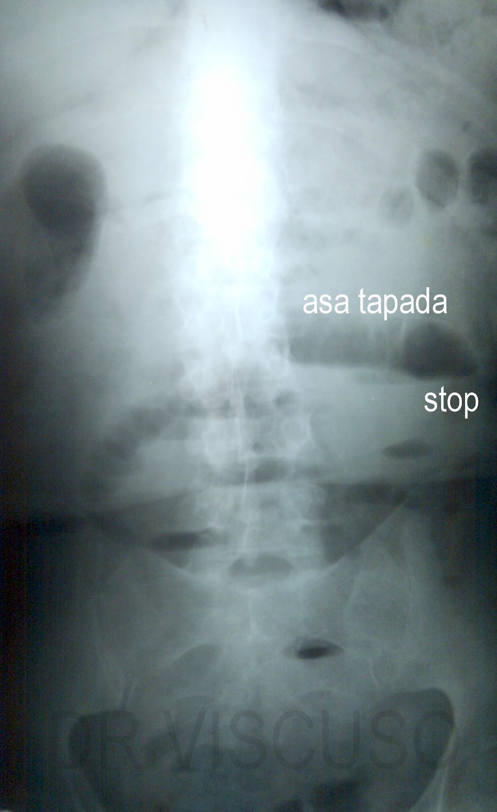 Que vi hoy: Eventración atascada