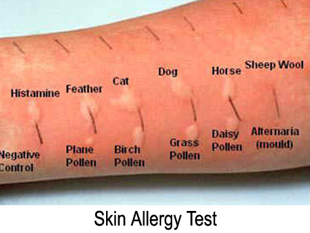 Allergies and Children: TEST FOR ALLERGIES