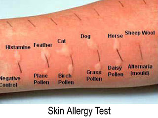Allergies and Children: TEST FOR ALLERGIES