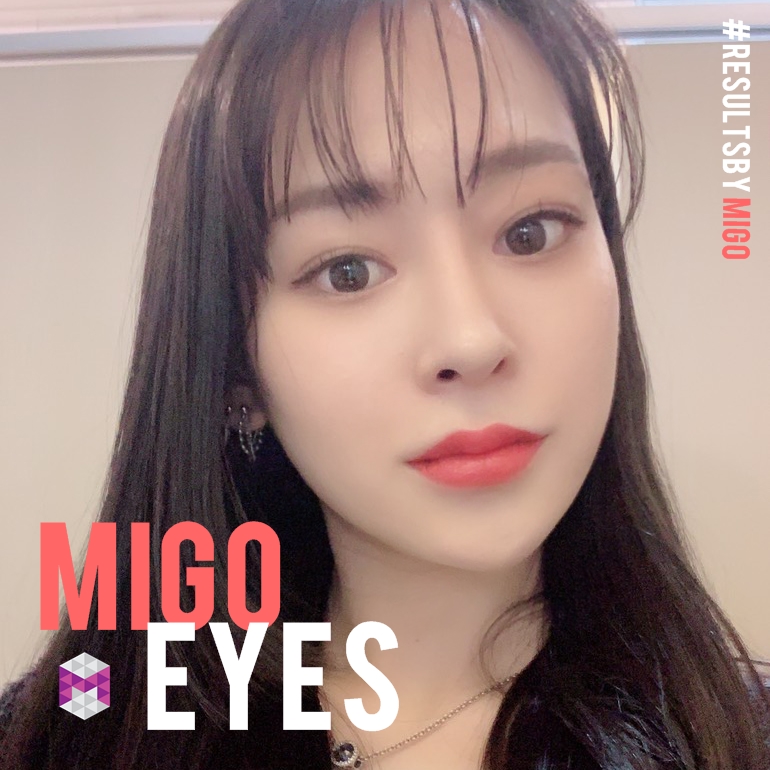 MIGO Eyes | The Non-incisional, suture method of Double Eyelid Surgery
