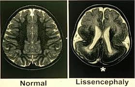 Medical Treatment Pictures-for Better Understanding: Lissencephaly