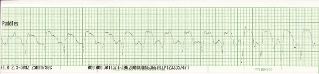 Float Nurse: Pulseless VF/VT