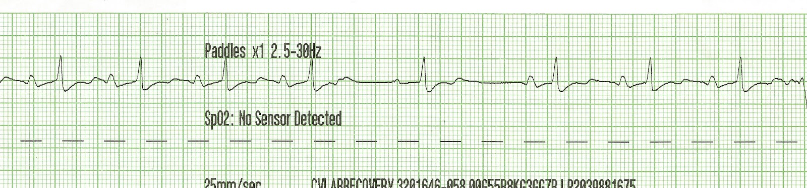 EKG Rhythm Strips 87: Cardioversion of Atrial Flutter