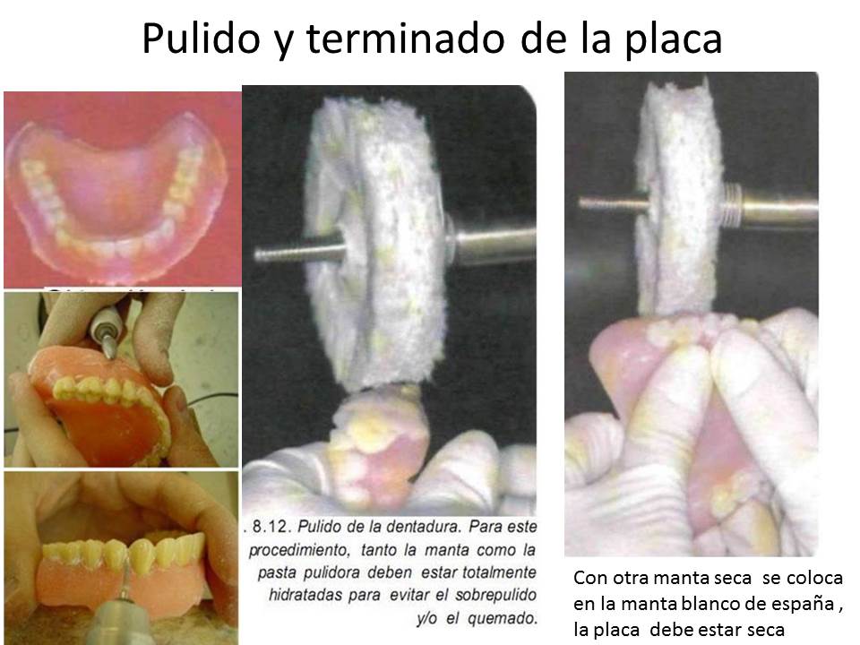 Verano Rehabilitación III: Continuación del 2° Parcial Placa Monomaxilar