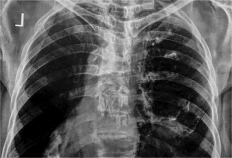 Fieggentrio: Erwtenplantje groeit in longen van een man.