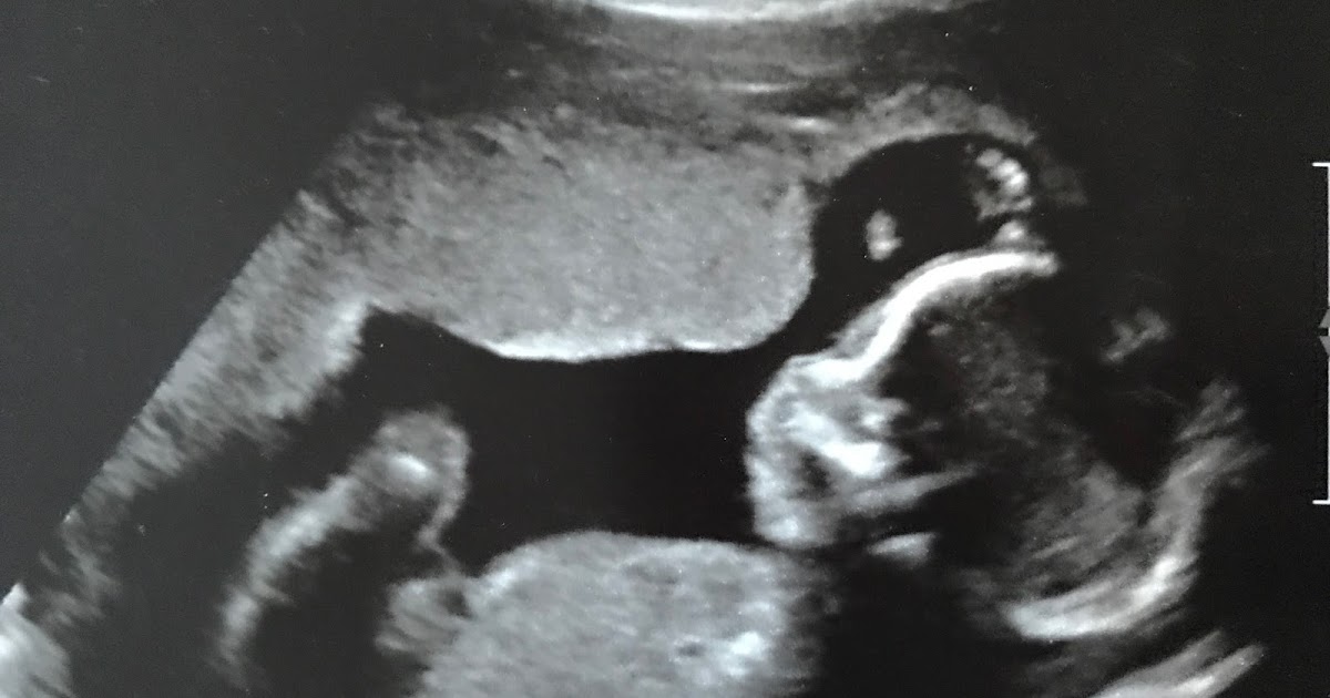 The 20 Week Ultrasound