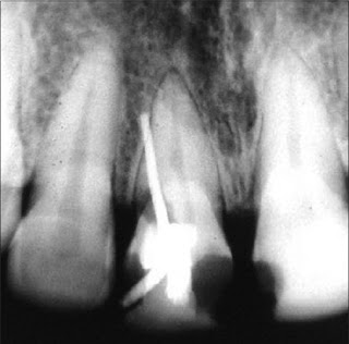 SUHASIS ONLINE: Non surgical perforation repair by mineral trioxide ...