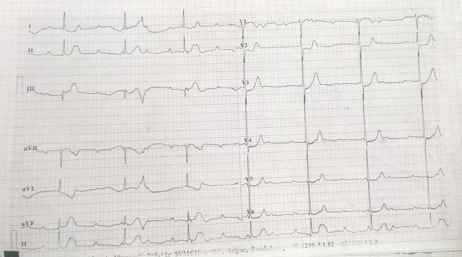 Cardiology window: Inferior wall myocardial infarction presenting as ...