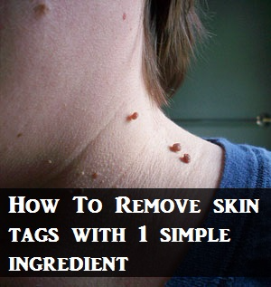How To Remove Skin Tags With One Simple Ingredient - FITNESS SHORTCUT