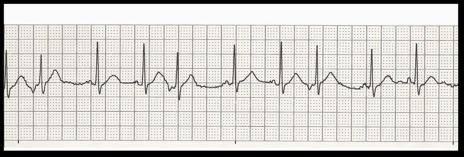 EKG Rhythm Strip Quiz 202
