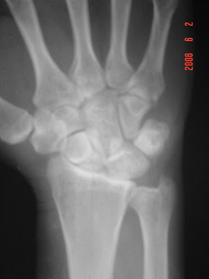 OSSA CARPALIA ©: Patomecánica de la mano reumática.