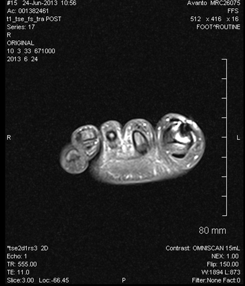 wtf is wrong with my toe???: Toe MRI