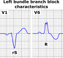 ECGs for EMS: Identification of the Left Bundle Branch Block (Part 1)