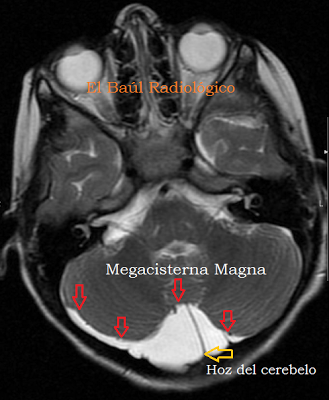El Baúl Radiológico: ASPECTO DE LA CISTERNA MAGNA EN TOMOGRAFÍA ...