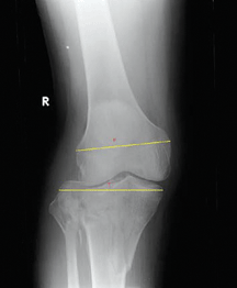 Sindrome Compartimental: Fatores predisponentes