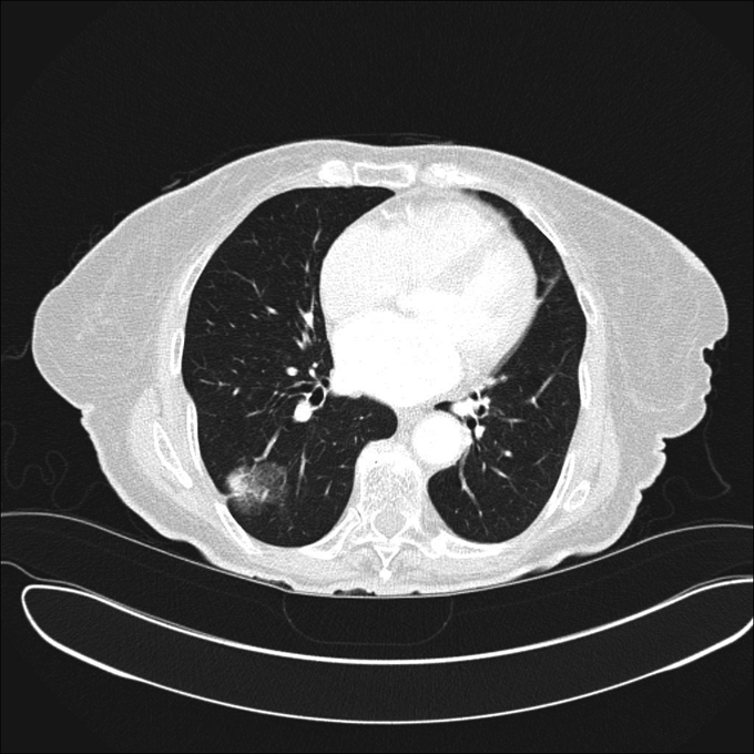 Vocal Nodules Symptoms Treatment More Cleveland Clinic