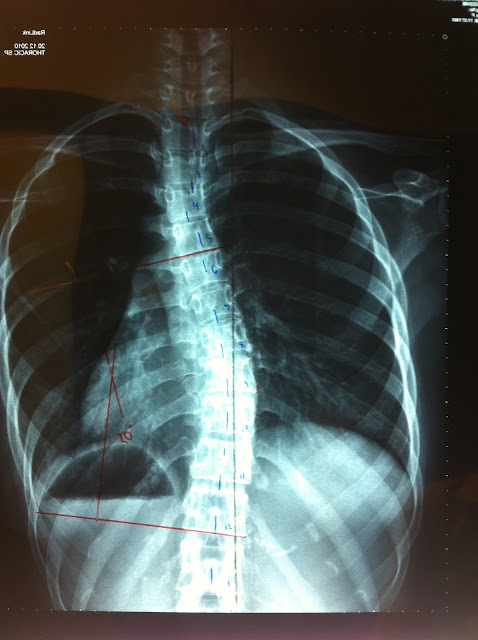 I Have A Crooked Spine