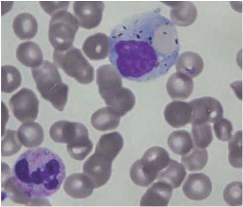 Medical Laboratory and Biomedical Science: Peripheral hemophagocytosis case