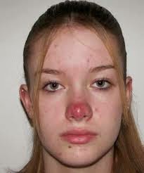 Dr Sherazi: Chilblains