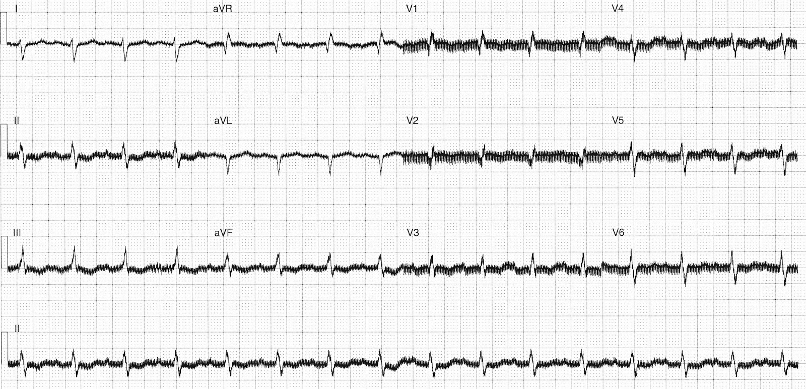 ECG of the Week: ECG of the Week - 13th June 2016 - Interpretation