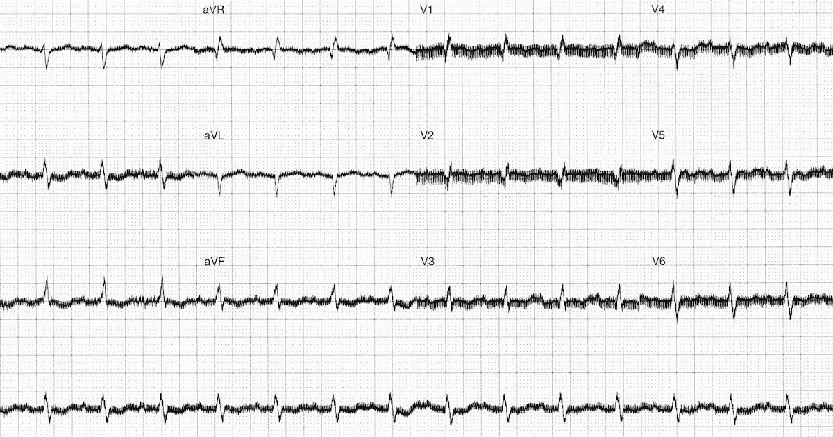 ECG of the Week: ECG of the Week - 13th June 2016 - Interpretation