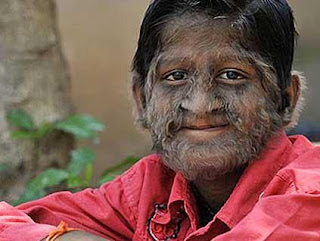 acrh.M.arch: The world's top ten weird diseases