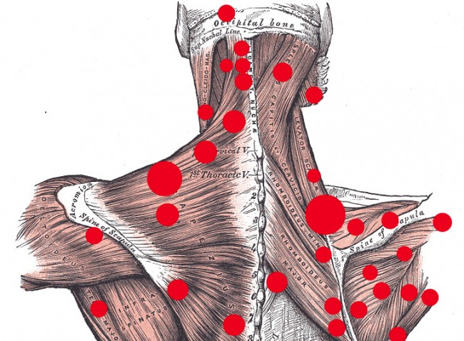 Cain Exercise Rehab: Is Self-Releasing Your Trigger Points Helpful?