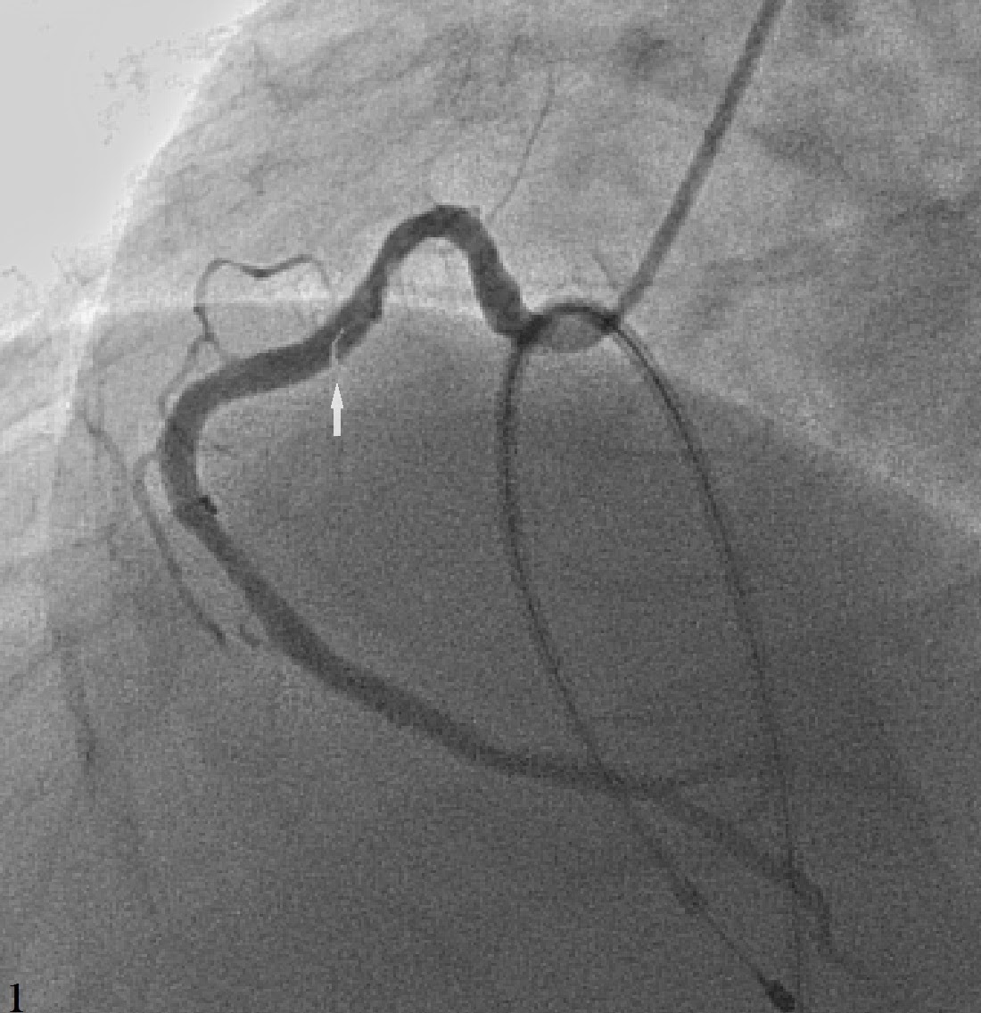 Dr. Laxman Dubey : Spontaneous coronary artery dissection (SCAD)