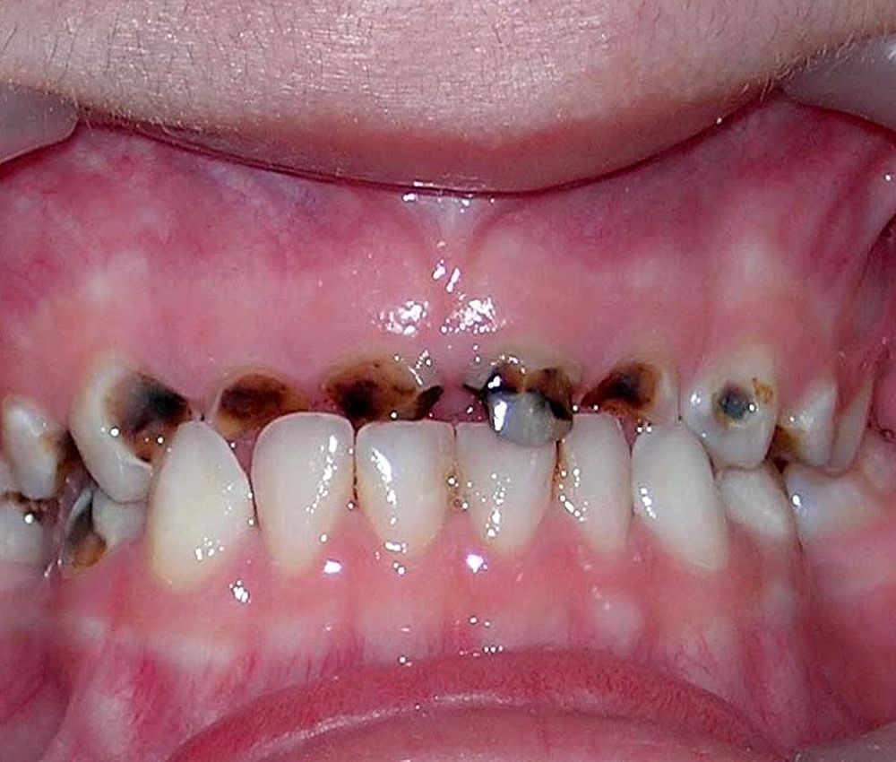 TOOTH DECAY Severe Early Childhood Caries An Integral Approach tooth-decay-severe-early-childhood-caries-an-integral-approach