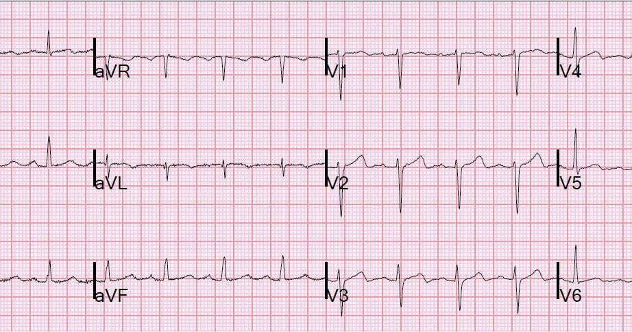 Dr. Smith's ECG Blog: Dynamic T-wave inversion (apparent Wellens' waves ...