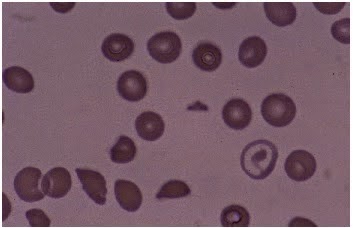Fichero de Hematología: Anormalidades de los eritrocitos.