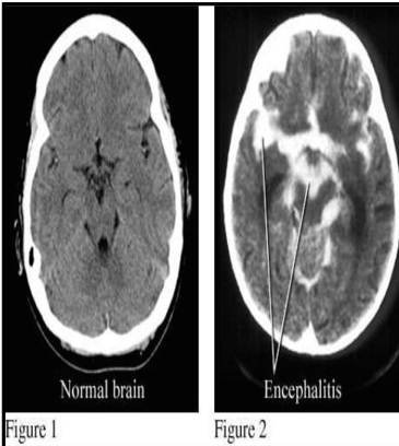 Encephalitis
