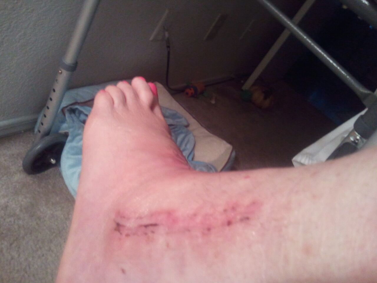 My Total Ankle Replacement: Post-op Photos - GRAPHIC!