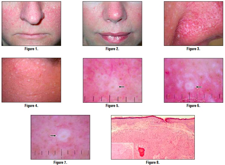 VIRTUAL GRAND ROUNDS IN DERMATOLOGY 2.0: April 2014