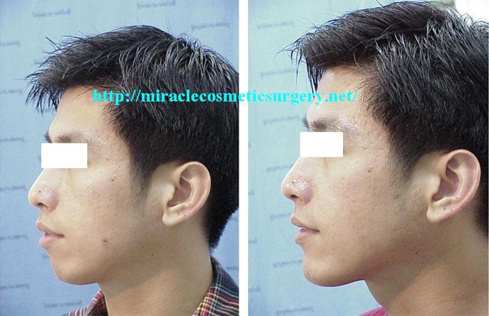 Plastic Surgery Photos: Chin Augmentation (Genioplasty or Mentoplasty ...