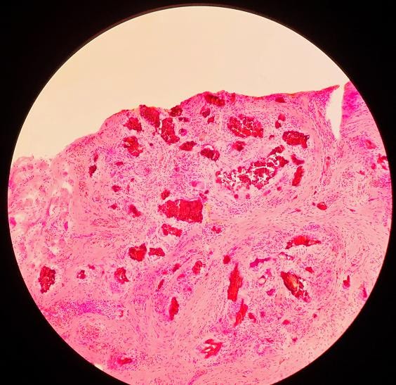 We Know Mohs: Slide Review: Monsel's Solution