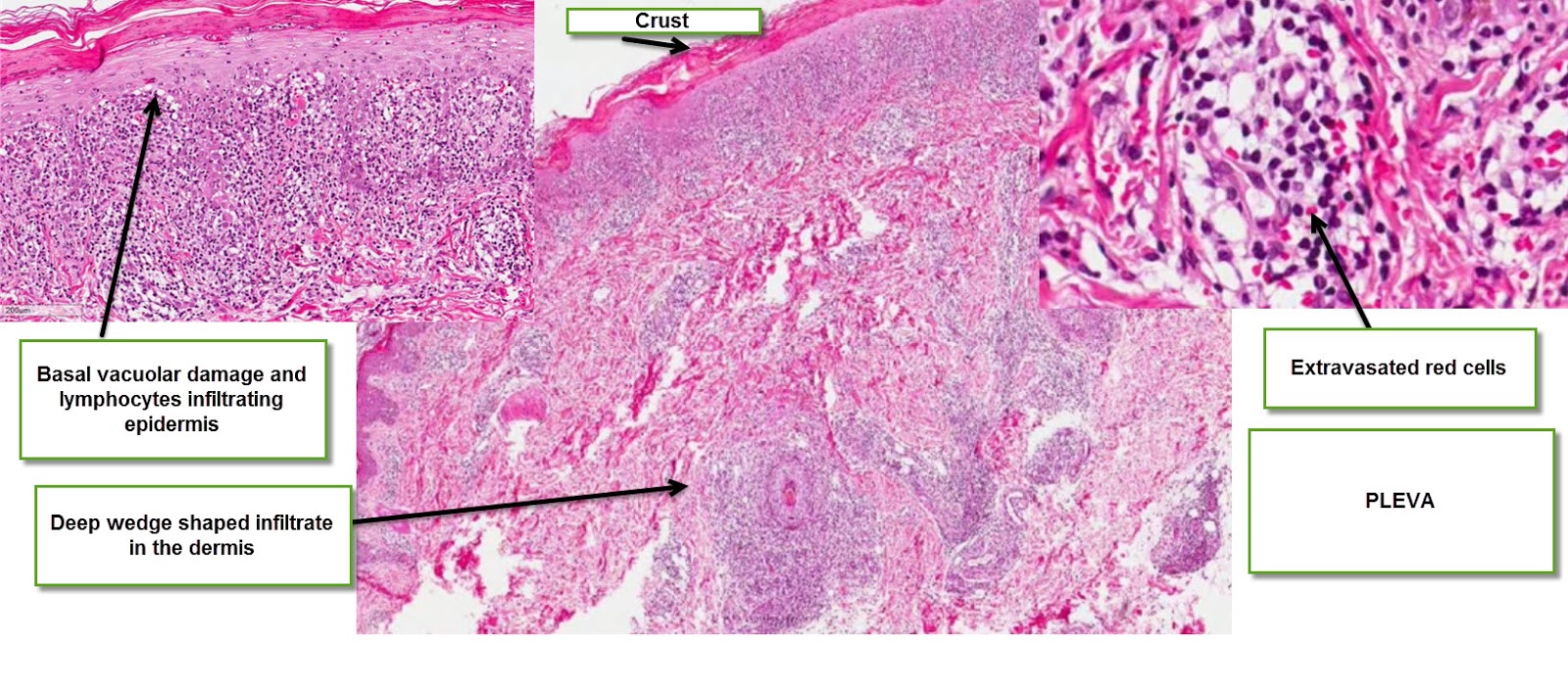 Dermatopathology Made Simple - Inflammatory: Superficial and Deep ...