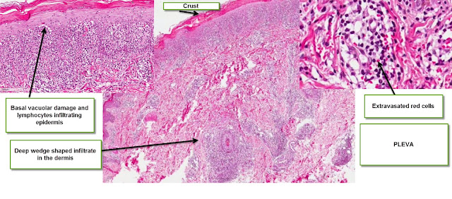 Dermatopathology Made Simple - Inflammatory: Superficial and Deep ...