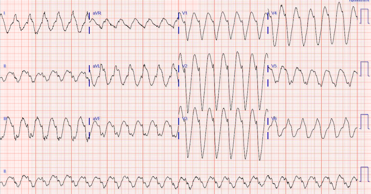 Wide complex ivcd - doplottery