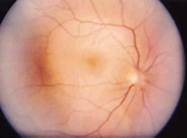 EPÓNIMOS: ENFERMEDAD DE BERLIN